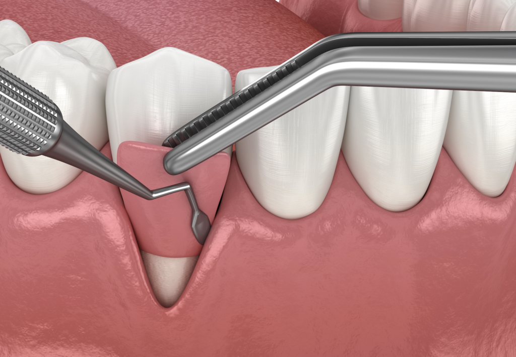 Importance Of Soft Tissue Grafting Around Implants | West Coast Institute